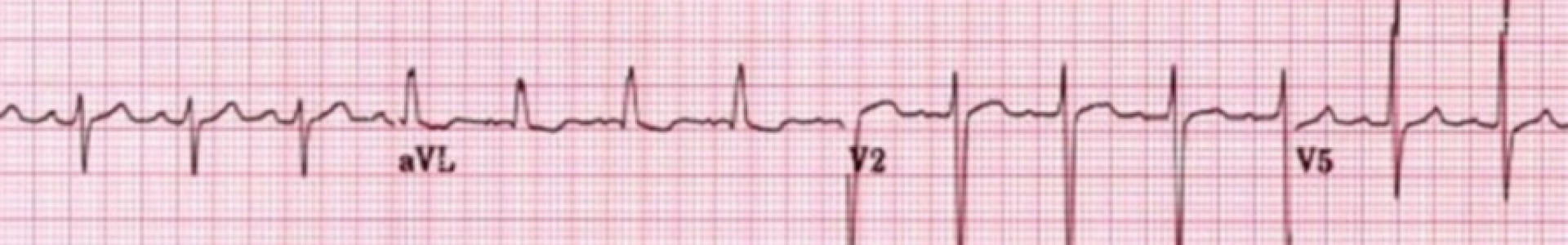 ECG & Cardiac Rhythm Recognition eLearning course | DREEAM